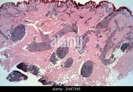 Leishmaniosi cutanea (CL): Lesione cutanea Foto stock - Alamy