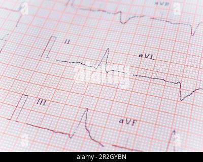 ECG / grafico ECG / grafico / grafico / grafico / tracciato che mostra ...