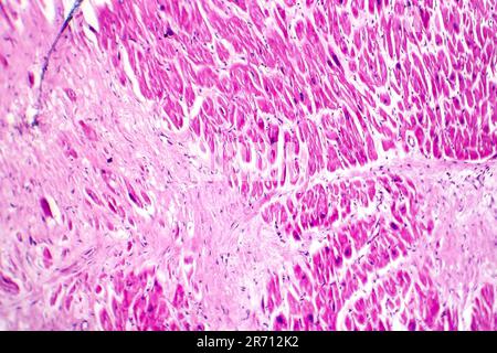 Infarto miocardico acuto, istologia del tessuto cardiaco, micrografia ...