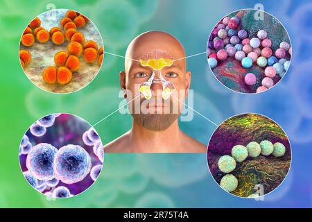 Rinosinusite in un uomo e batteri che causano sinusite. Streptococcus ...