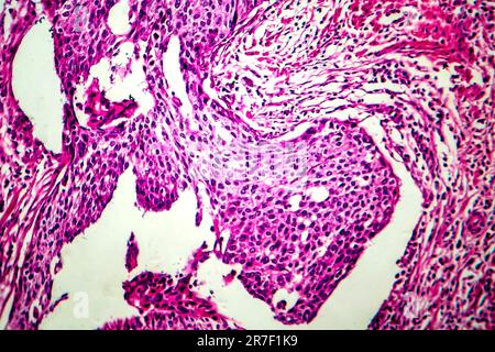 Il cancro cervicale. Micrografia di luce (LM) di una sezione di un carcinoma a cellule squamose ...