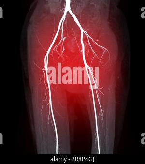 Anatomia umana dell'arteria femorale Foto stock - Alamy