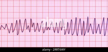 Immagine di un elettrocardiogramma (ECG) che mostra il ritmo di ...