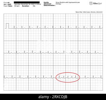 ECG / grafico ECG / grafico / grafico / grafico / tracciato che mostra ...