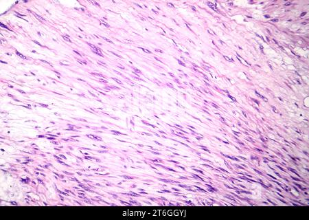Fotomicrografia del leiomiosarcoma, raffigurante cellule tumorali ...