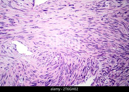Fotomicrografia del leiomiosarcoma, raffigurante cellule tumorali ...