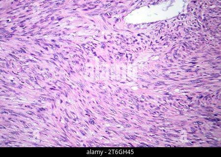 Fotomicrografia del leiomiosarcoma, raffigurante cellule tumorali ...
