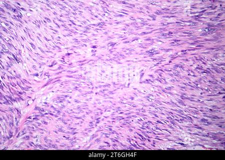 Fotomicrografia del leiomiosarcoma, raffigurante cellule tumorali ...