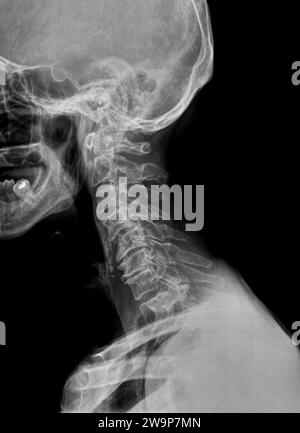 Pellicola radiografica o radiografia di un collo cervicale. Vista ...