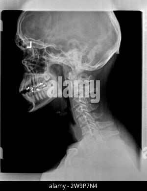 Pellicola radiografica o radiografia di un collo cervicale. Vista ...