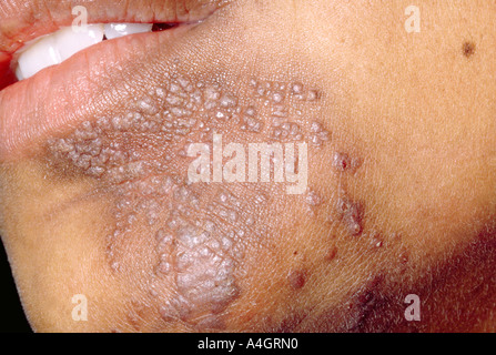 Verruca plana è un piccolo, color carne, con sommità piatta lesione che ...