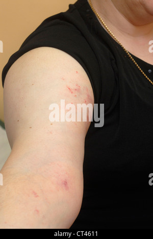 ANGIOMA DELLA PELLE Foto stock - Alamy