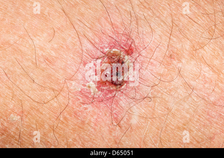 Il carcinoma a cellule basali del cancro della pelle. Close-up di un ...