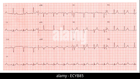 Elettrocardiogramma mostra il ritmo sinusale normale Foto stock - Alamy