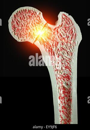 Sezione trasversale attraverso un modello di una frattura del collo del ...