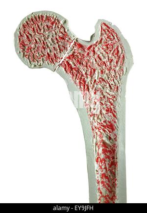 Sezione trasversale attraverso un modello di una frattura del collo del ...