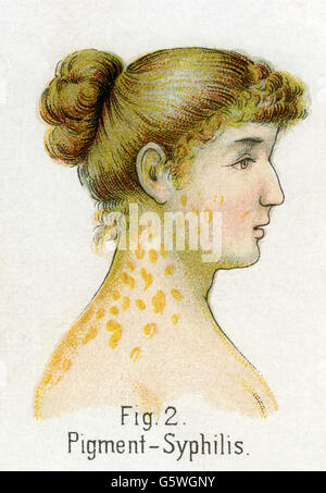 Medicina, malattie sessualmente trasmissibili, sifilide, sifilosi ...