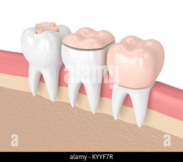 3D render di denti con intarsio, onlay e crown amalgama su sfondo ...