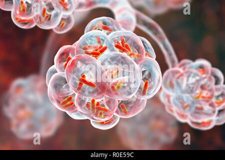 Una polmonite batterica. Computer illustrazione di a forma di asta ...