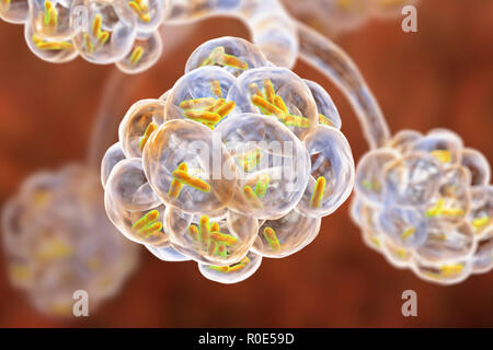 Una polmonite batterica. Computer illustrazione di a forma di asta ...