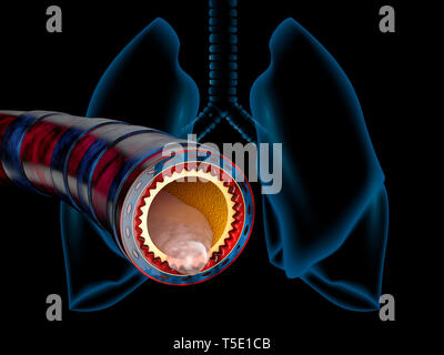 La bronchite anatomia, muco secreto come un freddo petto come 3D ...